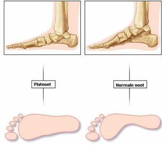 Platvoet (pes planus)