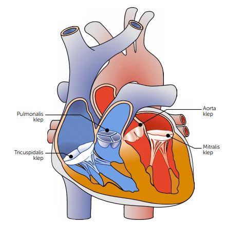Mitralisklepreparatie met MitraClip via een bloedvat in de lies