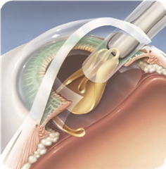 Staar (cataract en staaroperatie bij volwassenen)